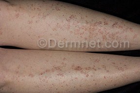 بیماری شامبرگ Schamberg disease